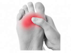 Capsulitis (Inflammed Toe Joints)﻿