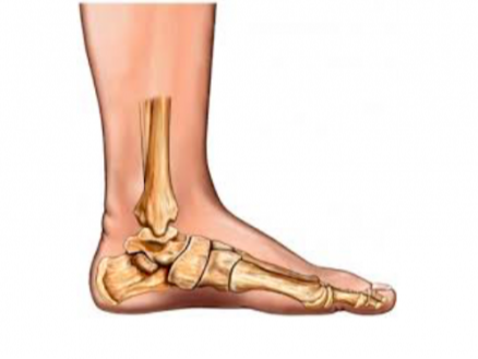 Pes Planus